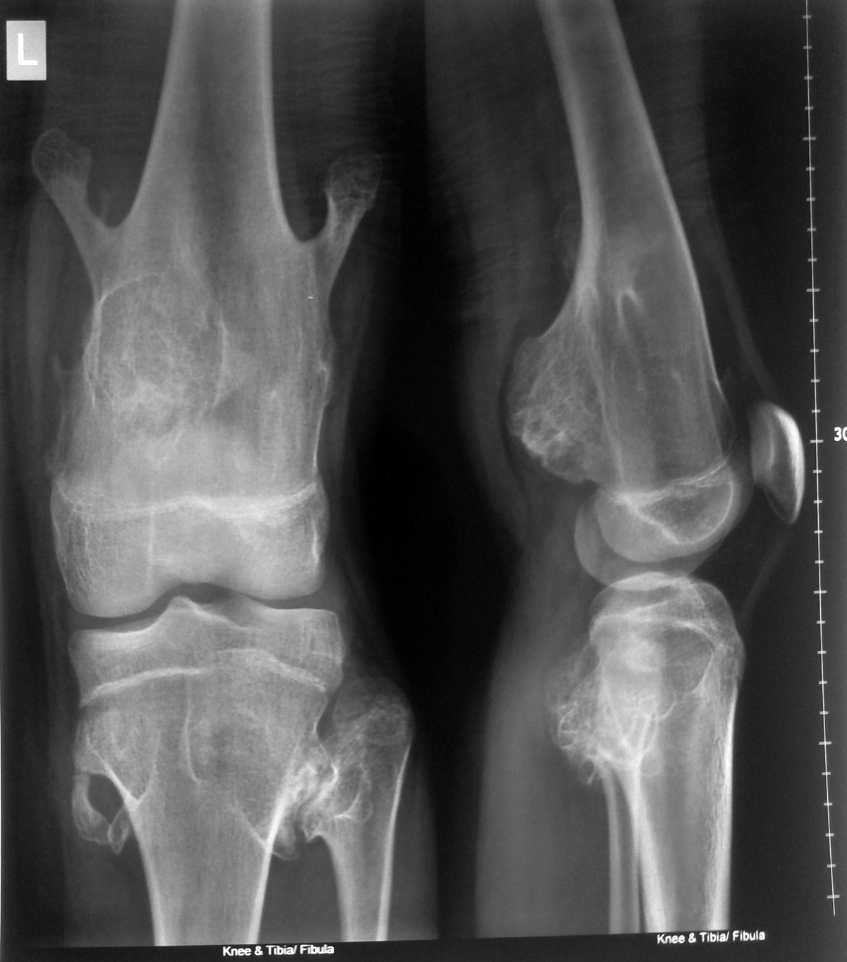 Radiodiagnosis Imaging Is Amazing Interesting Cases Diaphyseal