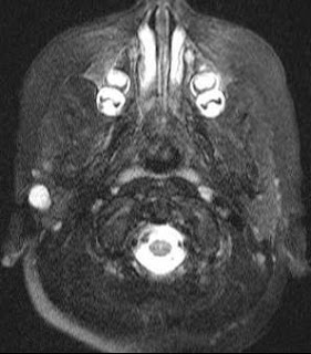 HU TU TU: First Branchial Cleft Cyst, Type 2