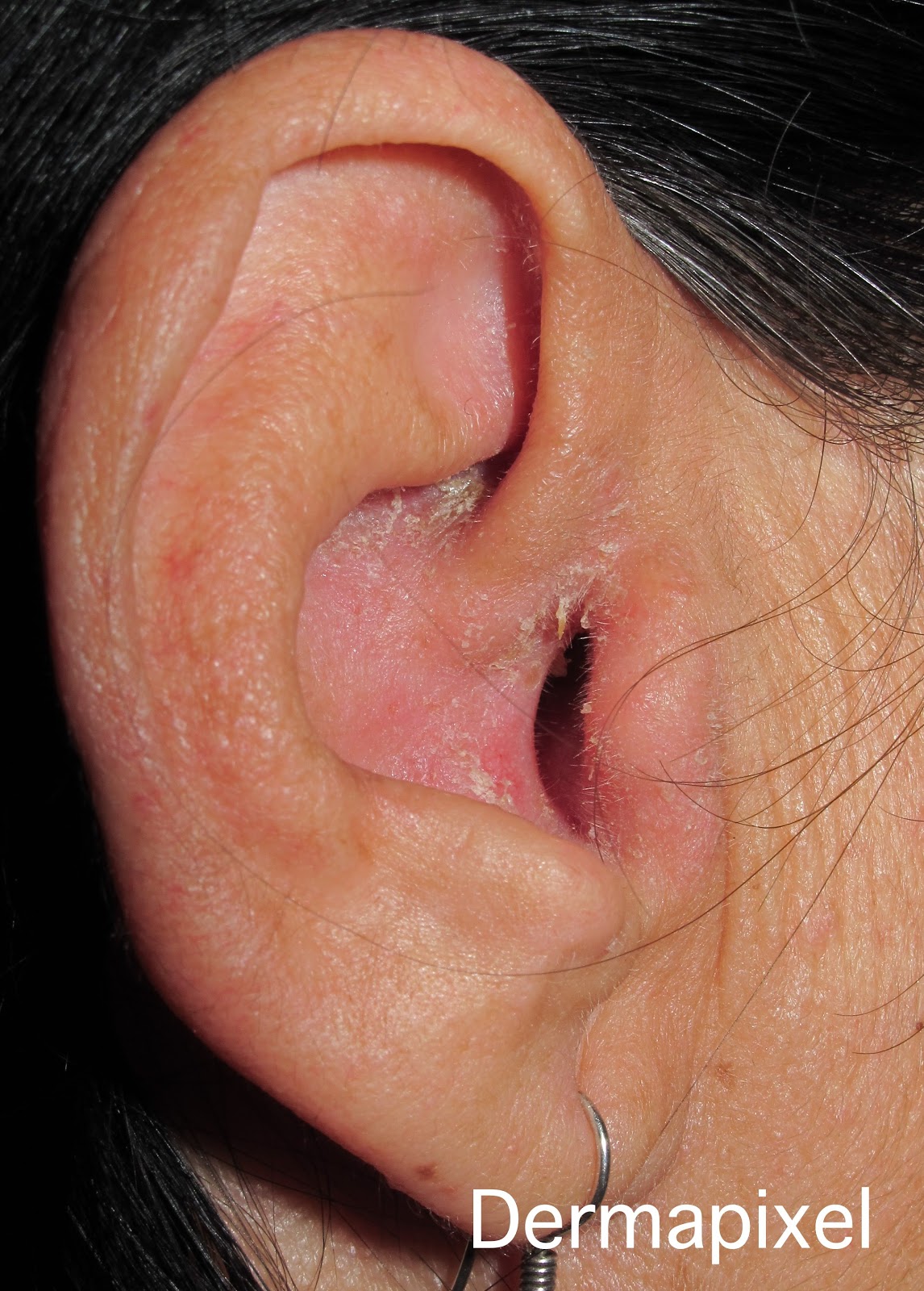 Tom Audreath Hubert Hudson Principiante dermatitis en pabellon ...