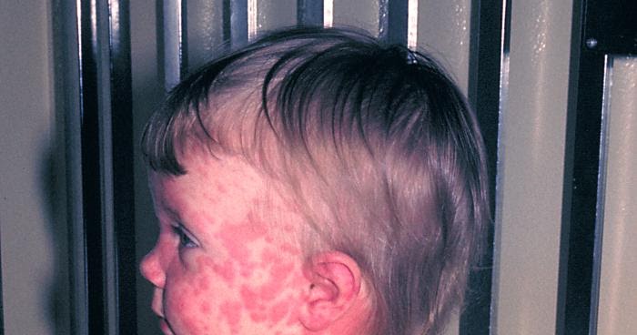 What Is Steven Johnson Syndrome