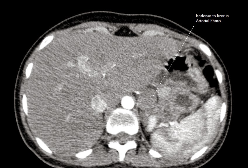 Ultimate Radiology : Pseudolesion : Papillary Process of Caudate Lobe