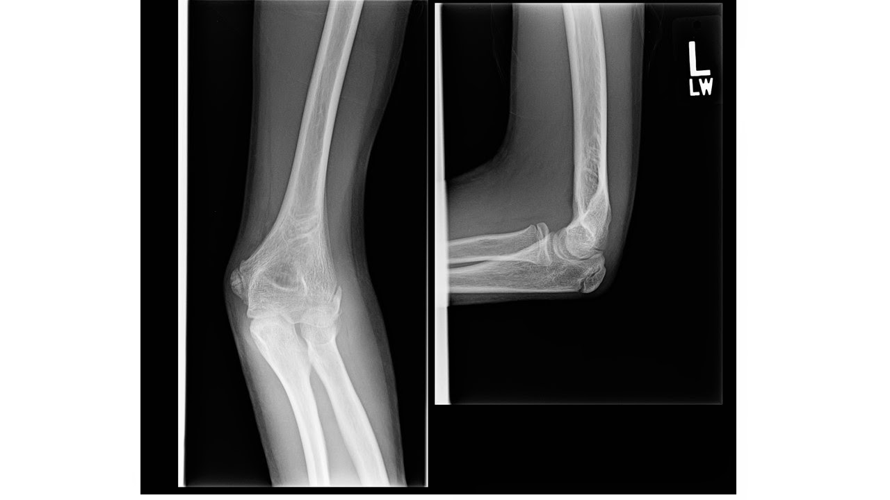 Shoulder and Elbow Surgery: Pediatric medial epicondyle elbow fractures