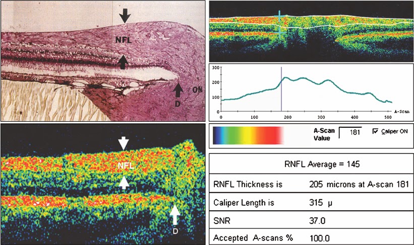 Correlation of the Visual Field and Optic Nerve Head Maps in Glaucoma