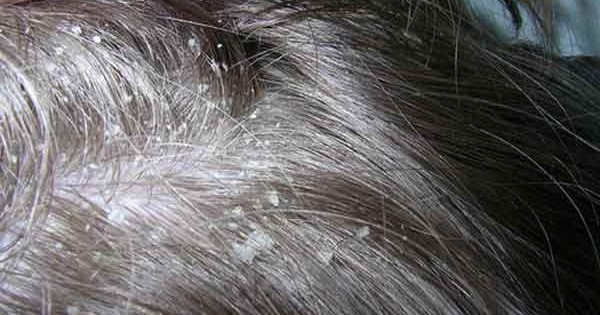 salutepiu: LA FORFORA