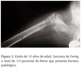 Fracturas asociadas a enfermedadneurológica