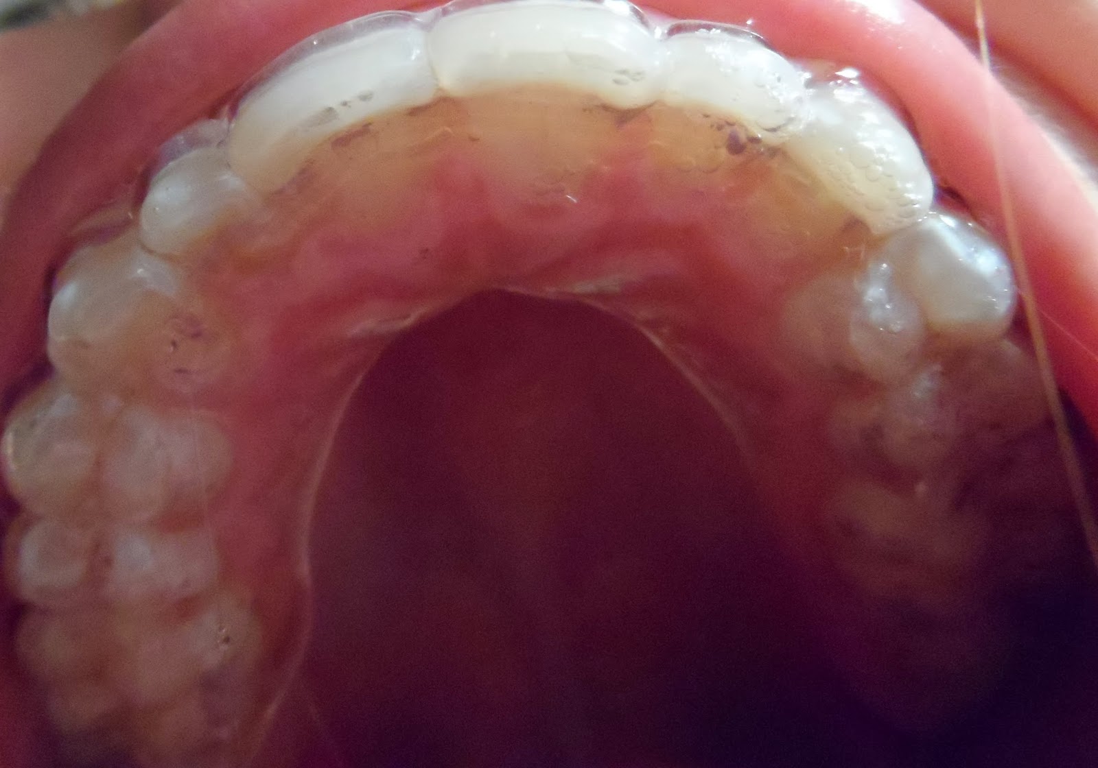 Orto druciki: Retainer