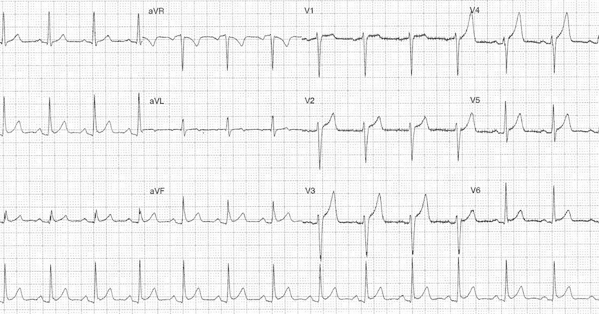 ECG of the Week: ECG of the Week - 24th December 2018 - Interpretation