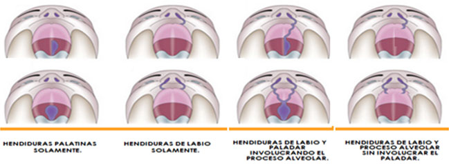 SEMINARIO INTERDISCIPLINARIO GRUPO 2016-2: Labio y paladar hendido ...