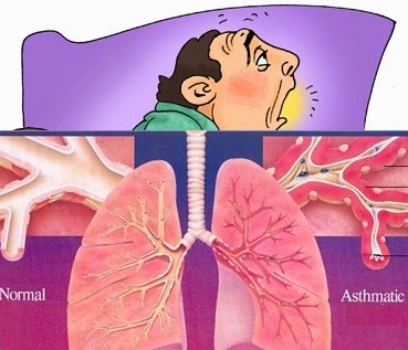Penyakit Asma Bronchial, Penyebab dan Pengobatan | Sehat Online