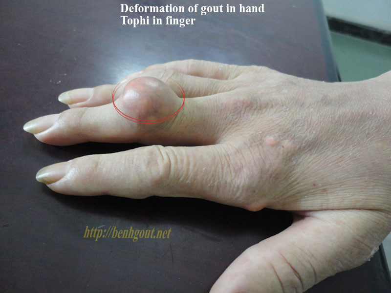 Nghiên cứu bệnh gout: Đặc điểm dễ nhận biết nhất của bệnh gút