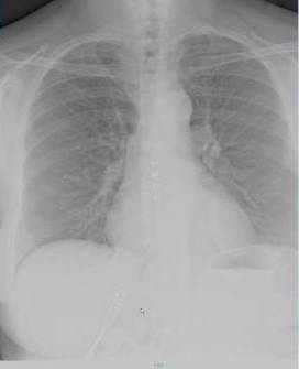 Another Implant for the Radiologists-Spinal Cord Stimulator - Sumer's ...