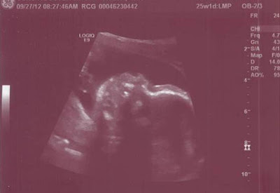 Luke: Lighting Up Our Lives: Level II Ultrasound at 25 Weeks