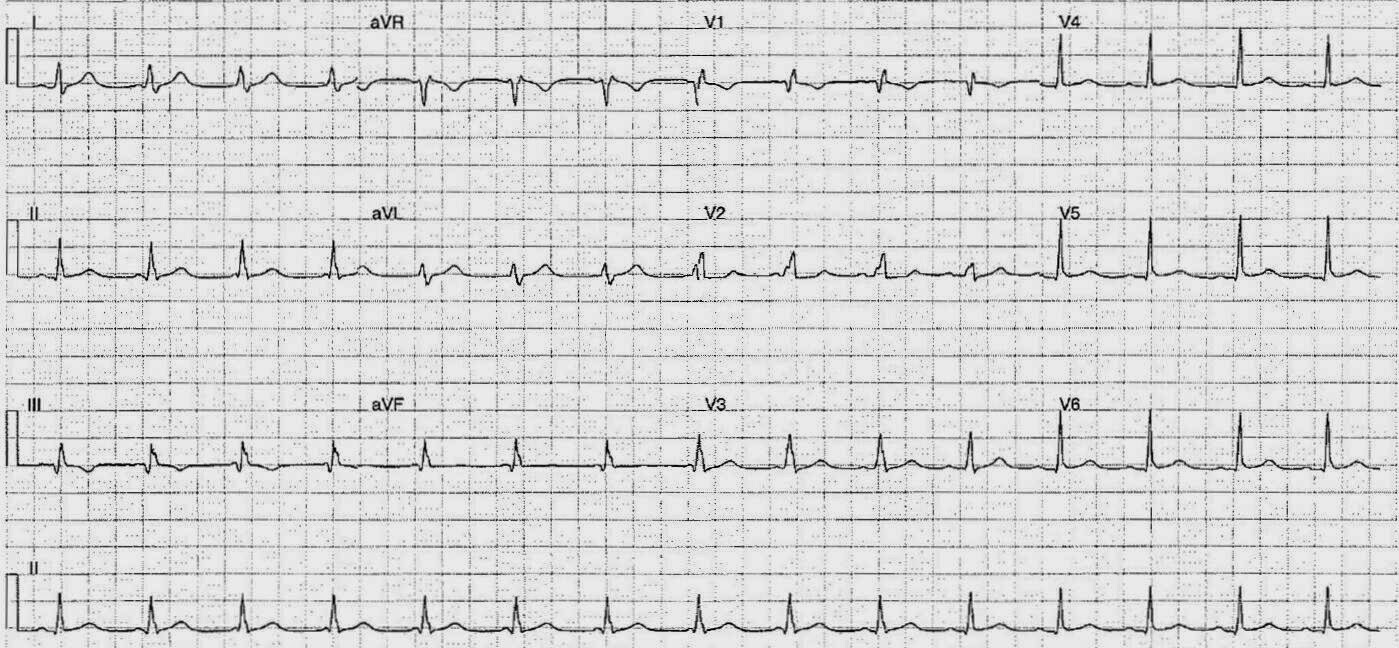 ECG of the Week: ECG of the Week - 19th May 2014 - Interpretation
