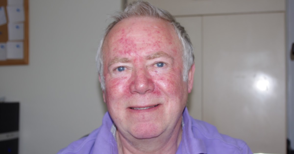 Alan's Efudix/Efudex Experience