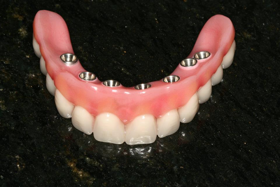 Studio Gorga: Prótese Protocolo