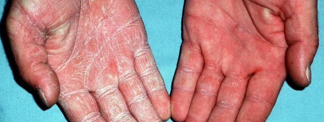Tinea Manuum Nedir? Nedenleri, Belirtileri, Tanısı ve Tedavisi