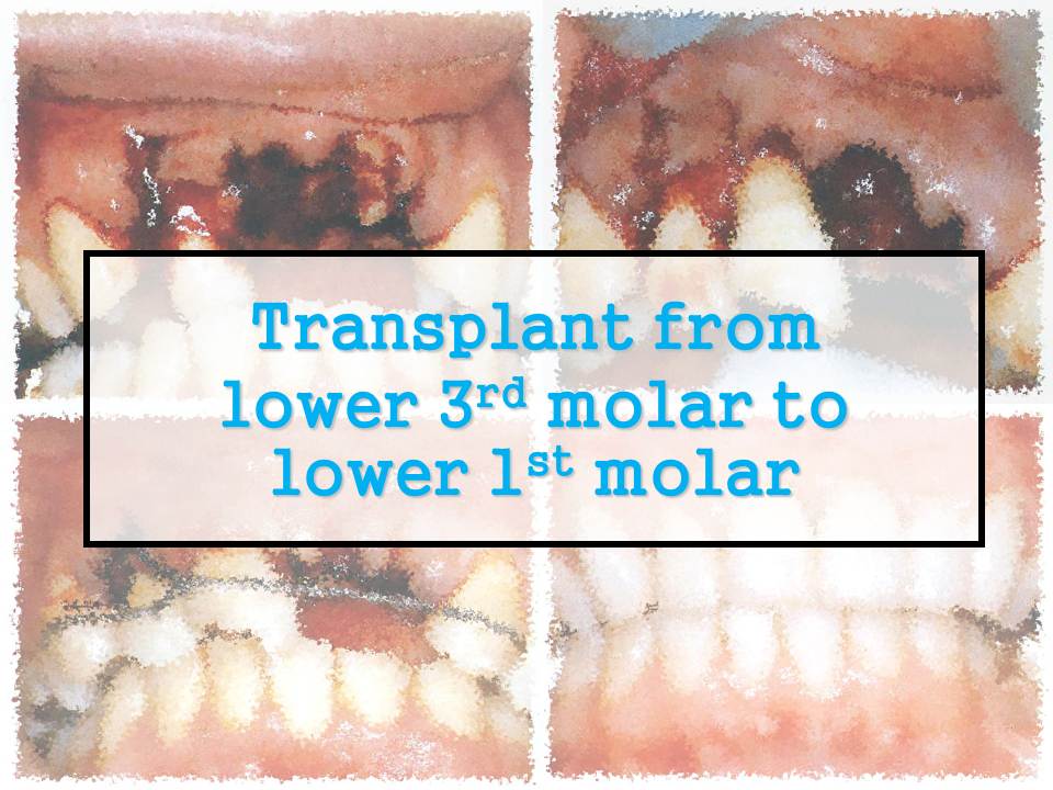 Dentistry: Tooth Transplantation