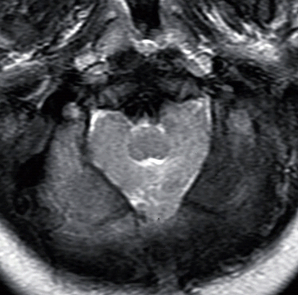 Chiari 2 malformation