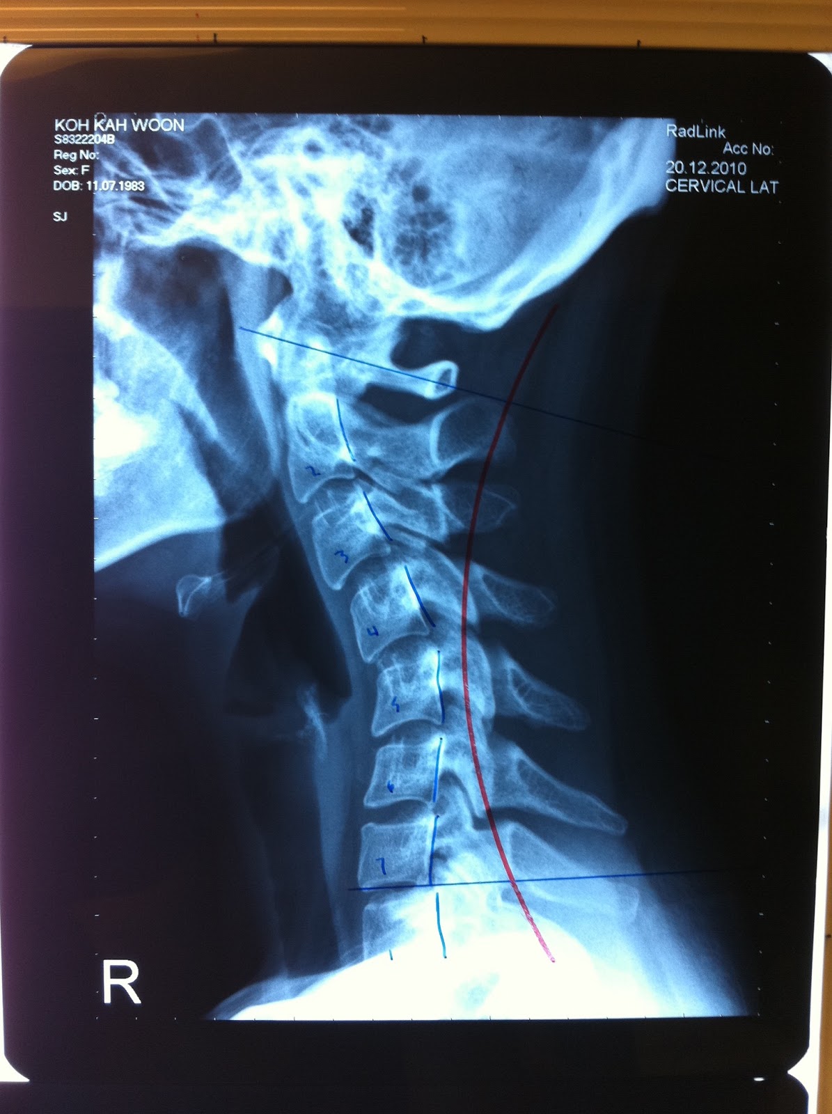 I Have A Crooked Spine