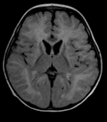 Leukodystrophy Teaching Points-MRI - Sumer's Radiology Blog
