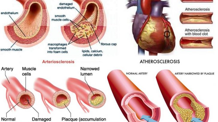 PREVENT THE DEADLY DISEASE BEFORE IT KILLS YOU ARTERIOSCLEROSIS 1 Healthy Living Useful prevent-the-deadly-disease-before-it-kills-you-arteriosclerosis-1-healthy-living-useful