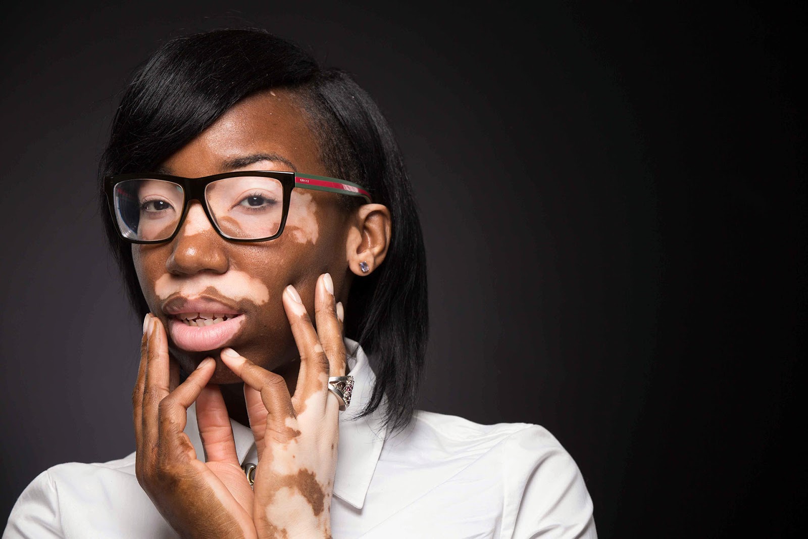 Watch This Poet Highlight The Beauty of Being A Vitiligo Model In 60 ...