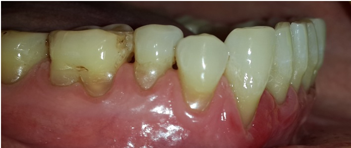 Dental Implants in Gurgaon, Dental Implants Clinic in Gurgaon