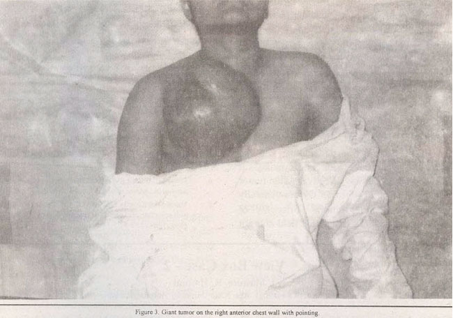 What Is Askin Tumor? - Teroes