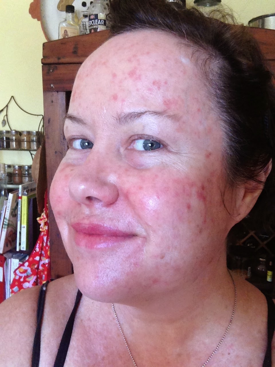 Efudex (Fluorouracil) Adventure: Efudex Days 1-9