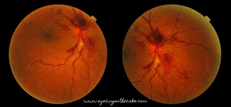 eyecing on the cake: central retinal vein occlusion
