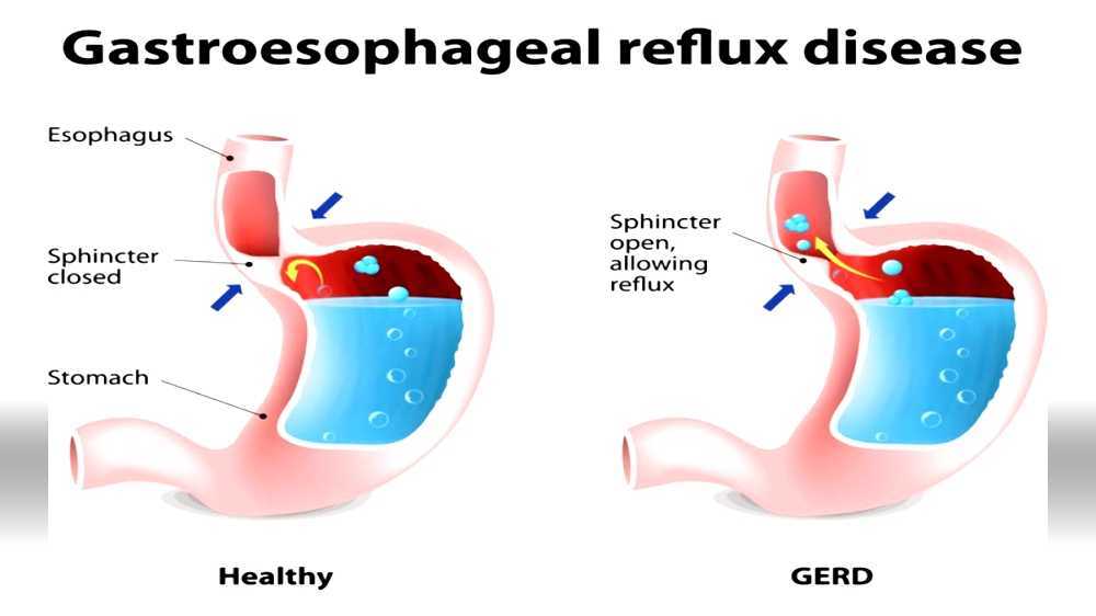 Gastroesophageal reflux disease