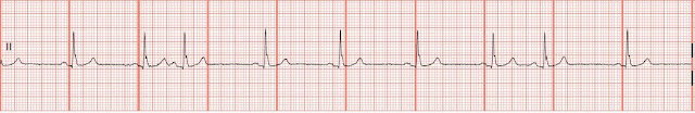 EKG Rhythm Strip Quiz 28