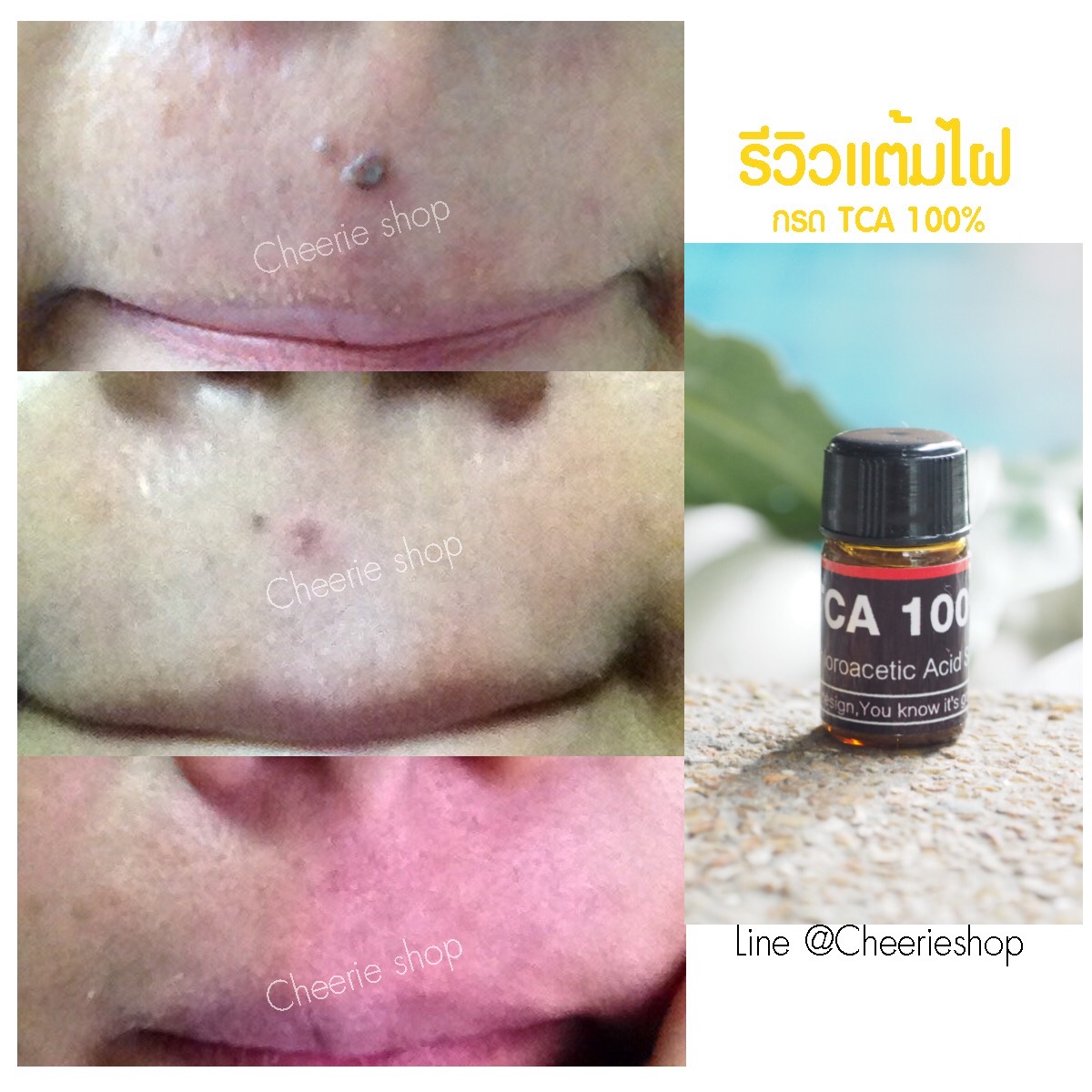 กรดTCA 100% 50% ใช้อย่างไร ให้เกิดประโยชน์ ไม่นำโทษมาให้เคืองใจ