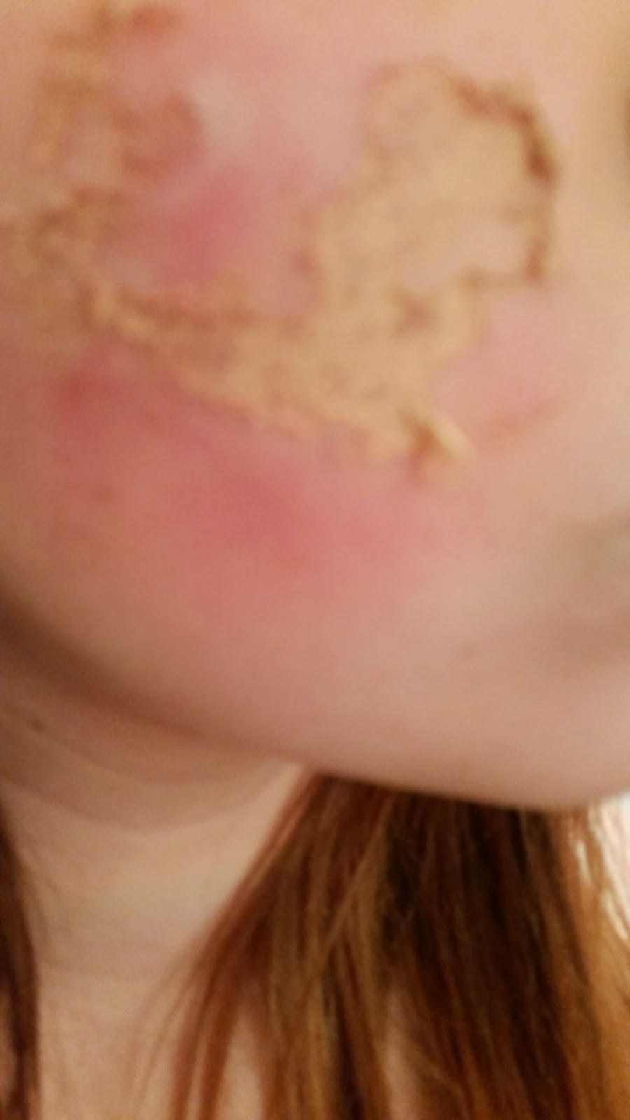 technical file: dry flakeykin sweat, fever, rashes and illness