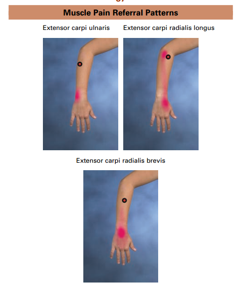 Elbow Muscle pain Referral Patterns
