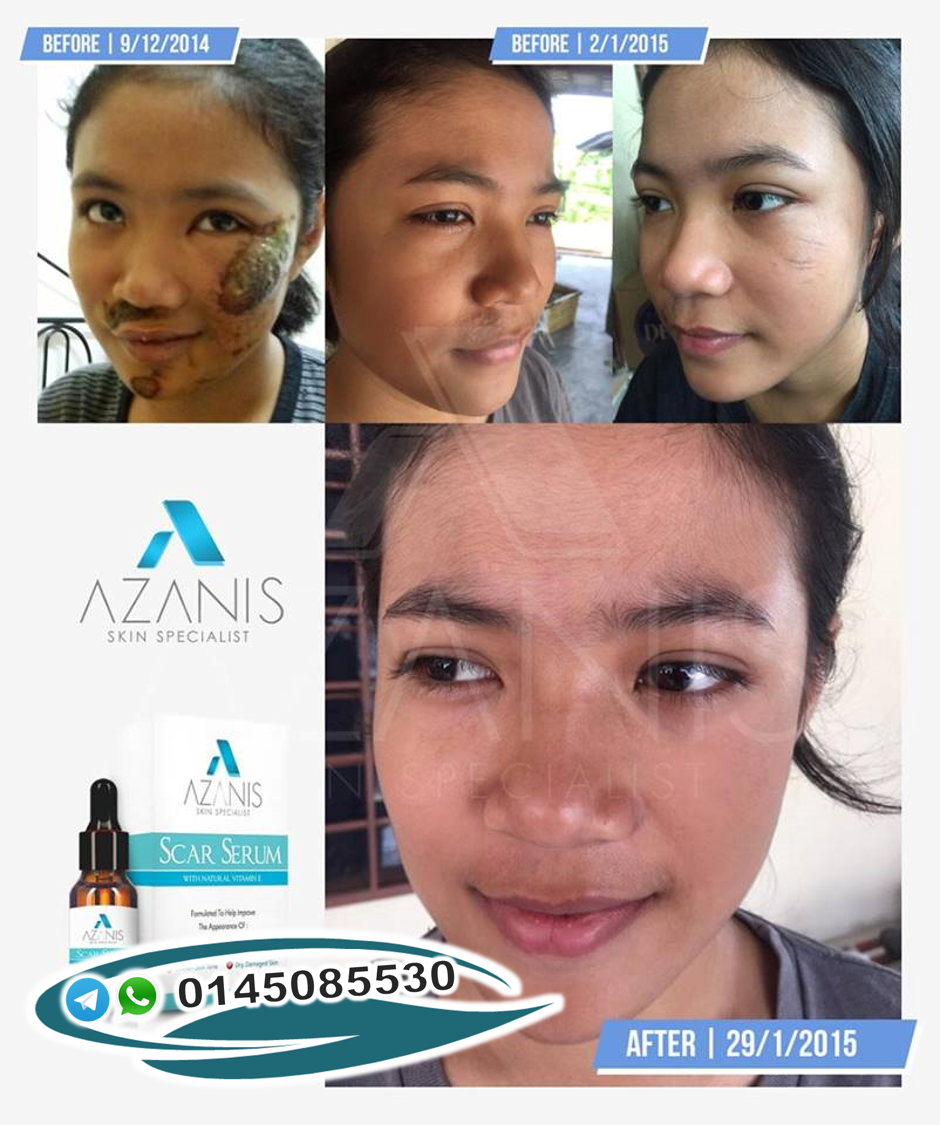 RAIHAN SHOP: Cara Mudah Hilangkan Parut Di Muka Dan Badan