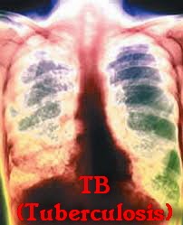 Obat Penyakit TB (TUBERCULOSIS) USUS Herbal Alami | Pengobatan ...