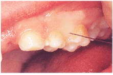 hiphoplife: Intrapapillary injection technique for children