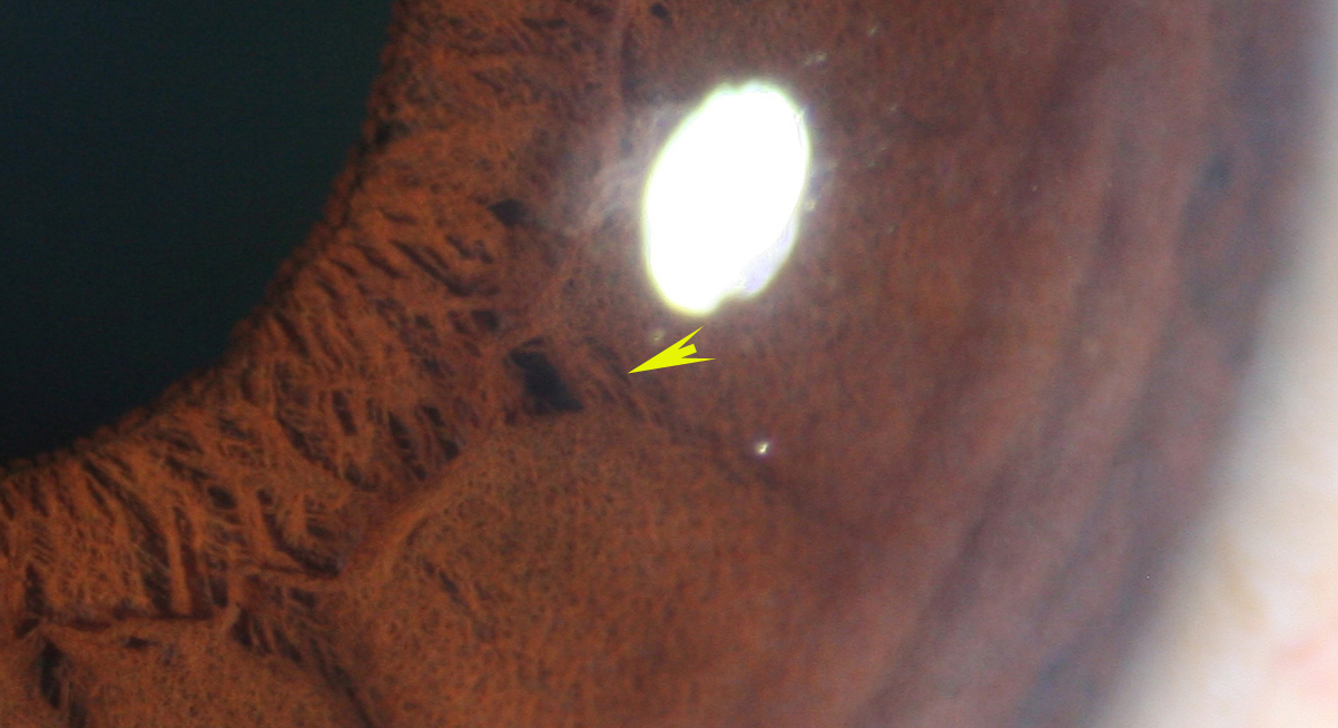 Modern & Multidimensional Iridology: The Collarette Structure & Signs ...