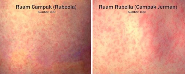 Perbedaan Antara Campak dan Rubella | Medkes