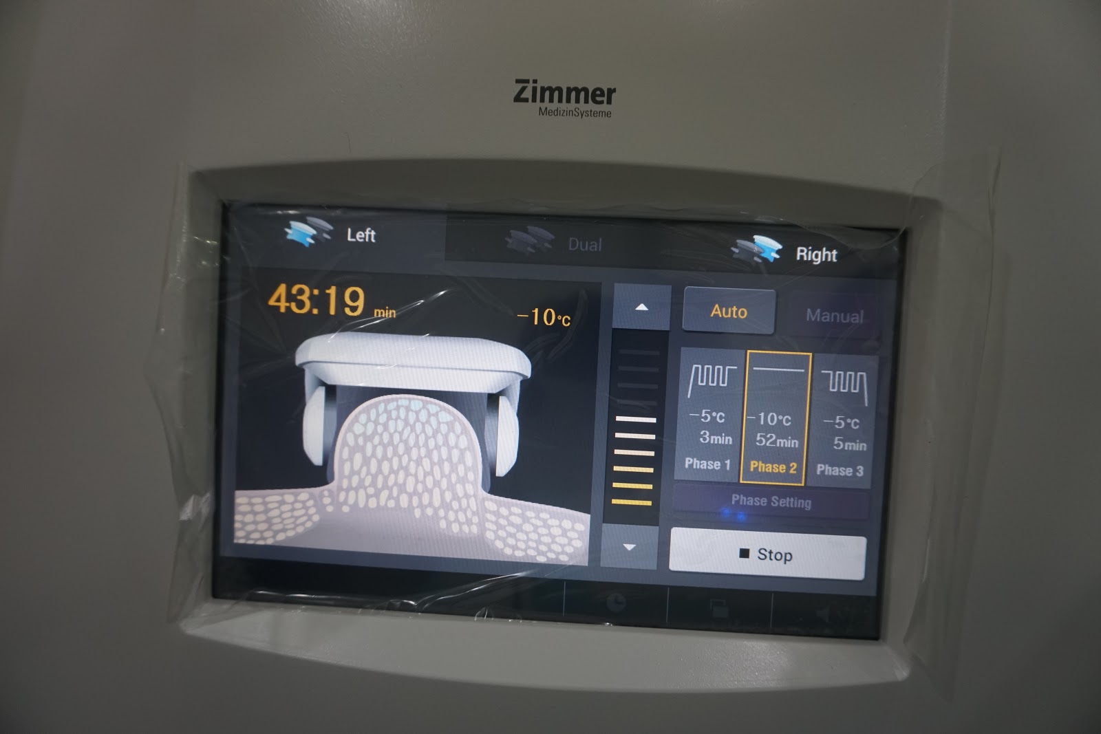 5 Little Angels: Z Lipo and Z Wave for Fat Reduction and Body ...