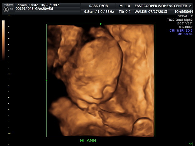 Here Comes Baby James: 20 Week Anatomy Scan