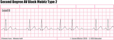 ECG Educator Blog : Six Second ECG Rhythm Strips