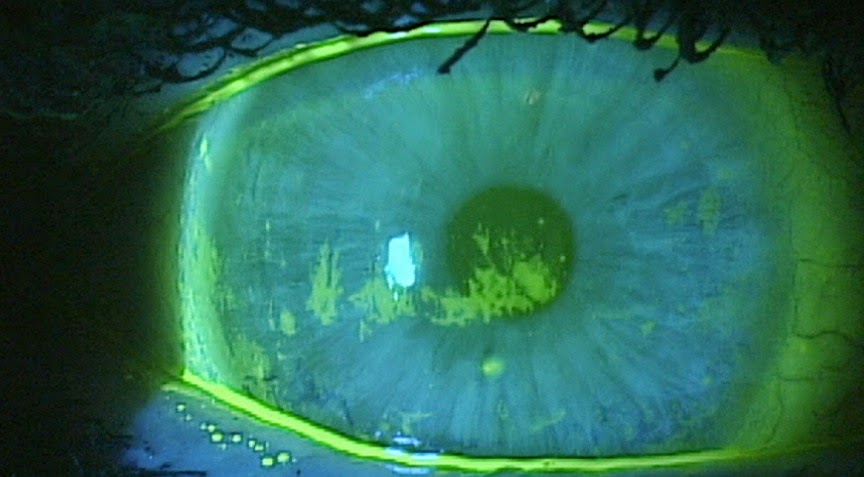 Corneal Spk Staining