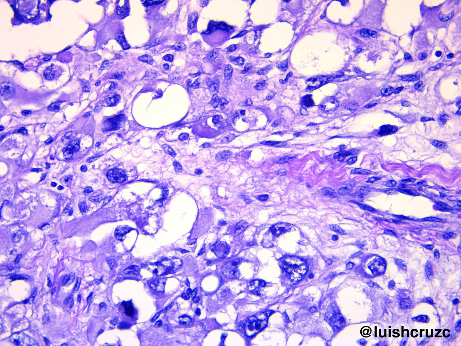 Patología CC: Blastoma pleuropulmonar tipo II / Pleuropulmonary ...