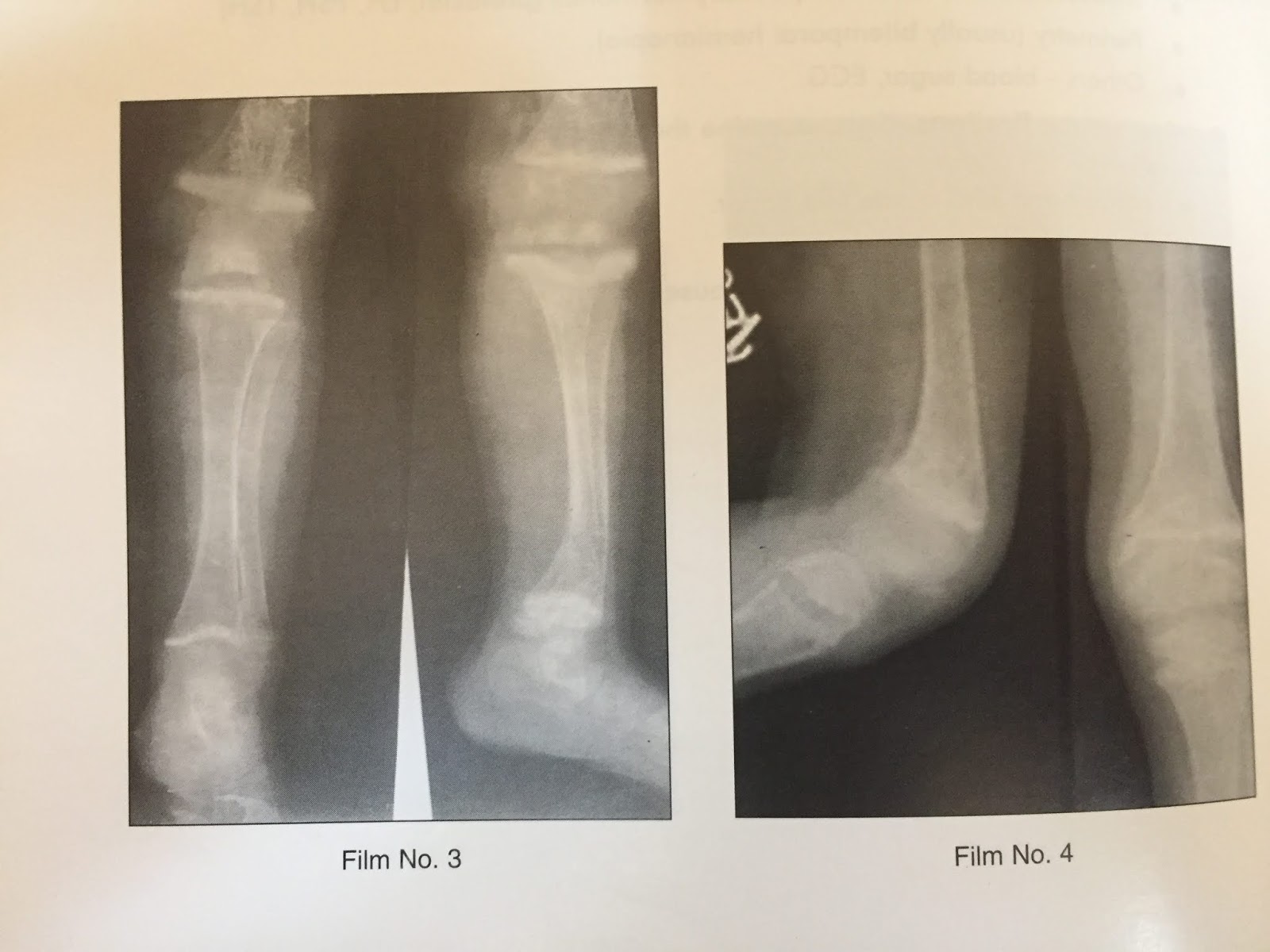 XRAYS OF RICKETS DISEASE