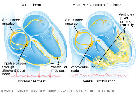Ventricular Fibrillation | INA - ECG