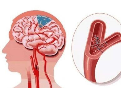 Stroke Warning Signs You Shouldn't Ignore! - Health Cares