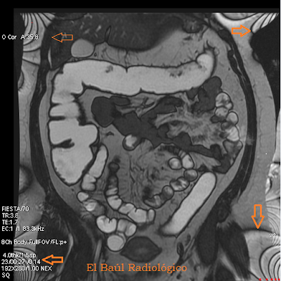 El Baúl Radiológico: BANDAS DE MOIRÉ EN LAS SECUENCIAS DE ECO DE ...