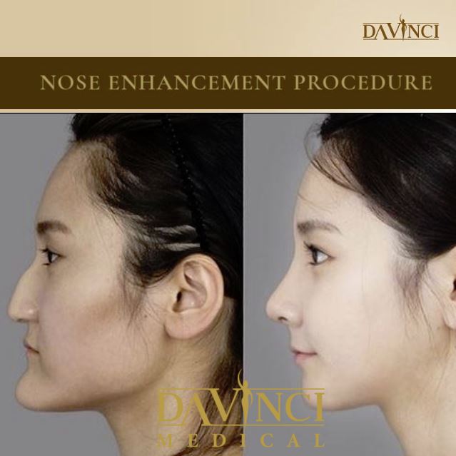 Angel Belle Faith: Nose Enhancement and Rhinoplasty Pre and Post ...